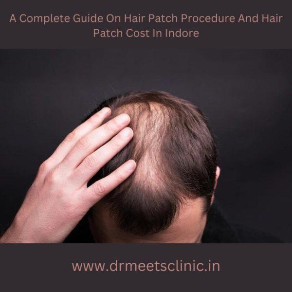 Guide On Hair Patch Procedure And Hair Patch Cost In Indore