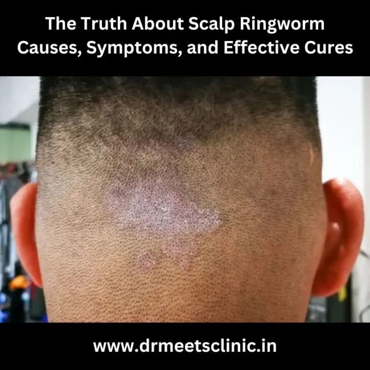 Mild Ringworm On Scalp What To Do When You Have Scalp Fungus? | Vinmec