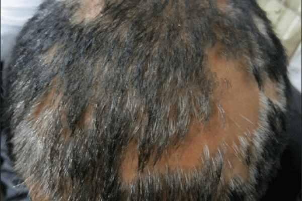 Trichology - Trichology and Cosmetology Specialist | Dr. Meets Clinic